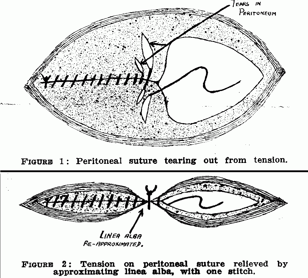 Tearing out of peritoneal suture